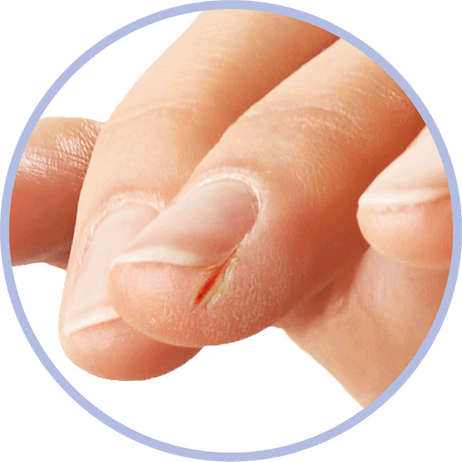 le ragadi – Rhagadil